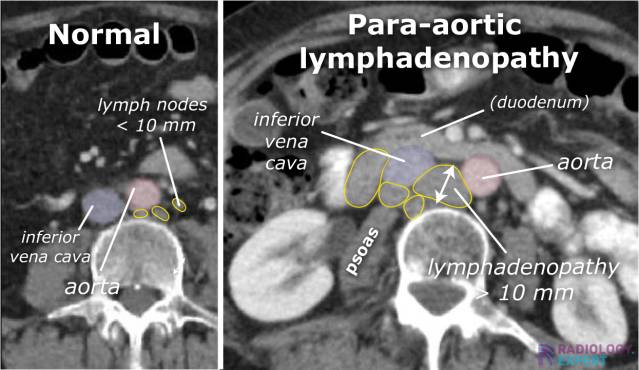 Ct Abdomen General